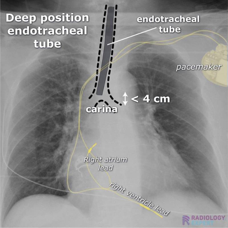Chest X-ray ICU